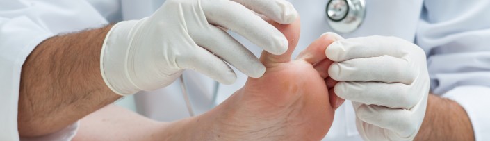 Voetschimmel - Hanssen Footcare