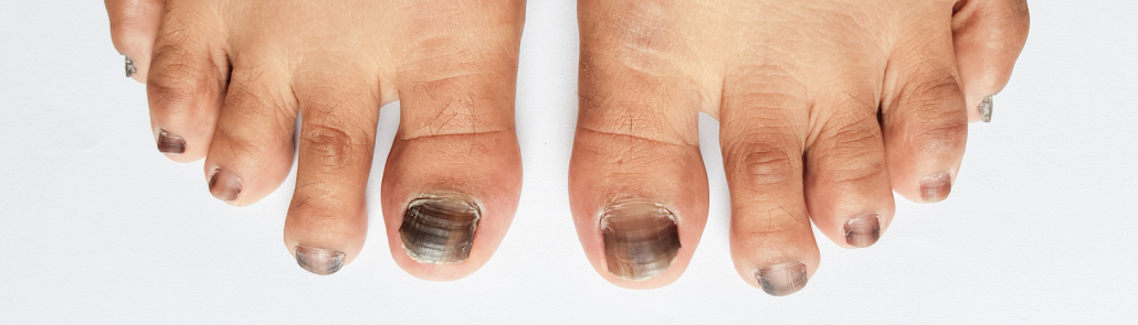 Voeten en Kanker (oncologische voet) | Hanssen Footcare