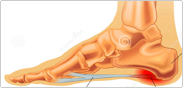 Fascitis plantaris (onteking peesplaat) - Hanssen Footcare